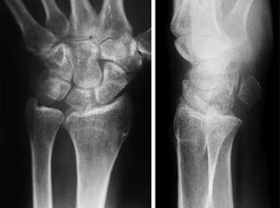 TFCC Injury - Hand - Orthobullets